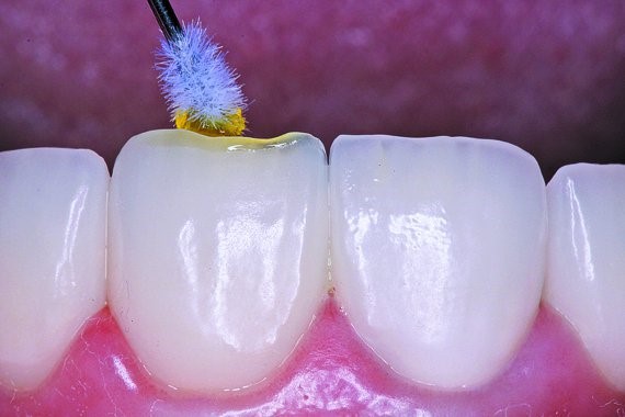 How To Repair Porcelain Restorations Instead Of Replacing Them
