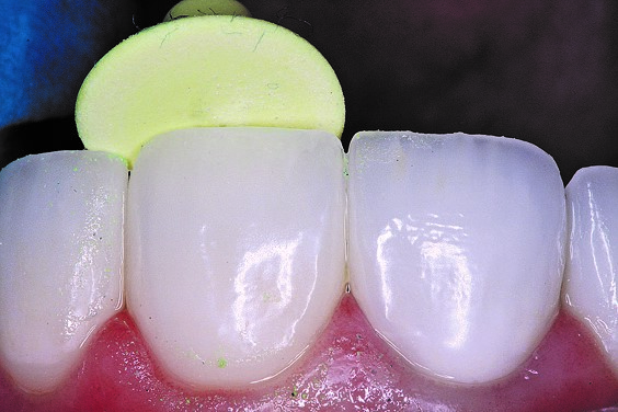 How To Repair Porcelain Restorations Instead Of Replacing Them